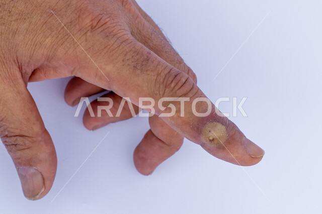 Minor injuries and acupuncture results, human skin diseases, close-up ...