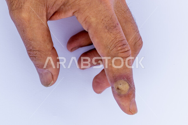 Minor injuries and acupuncture results, human skin diseases, close-up ...