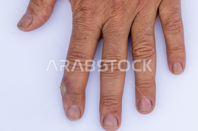 Pus collection in the skin and subcutaneous tissue, the necessity of ...