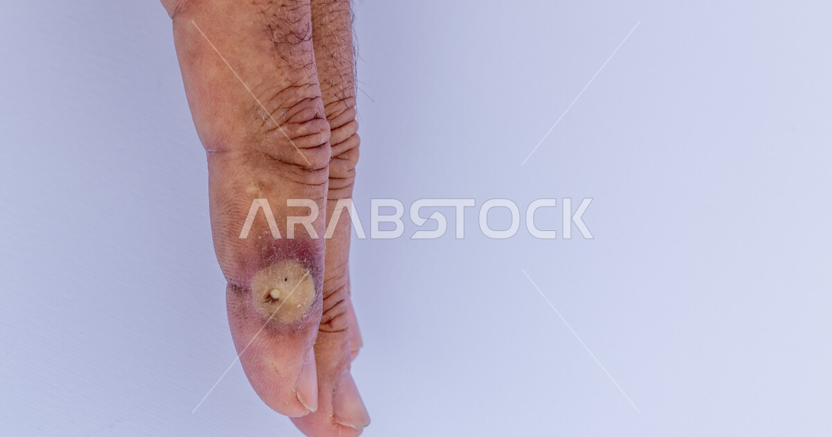 Pus collection in the skin and subcutaneous tissue, the necessity of ...