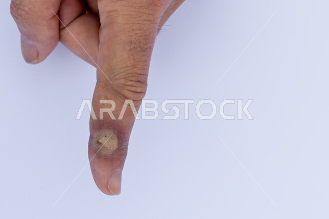 Human skin diseases, close-up of the hand of a Saudi Arabian Gulf man ...