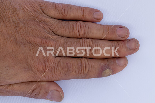 Human skin diseases, close-up of the hand of a Saudi Arabian Gulf man ...